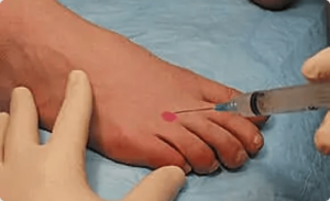 Ultrasound Guided Ablations - The Center Of Mortons Neuroma