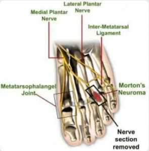 Post-Surgical Pain, Stump Neuroma Revision Surgery
