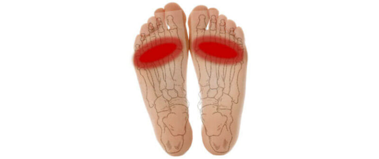 All About Metatarsalgia - The Center for Morton's Neuroma