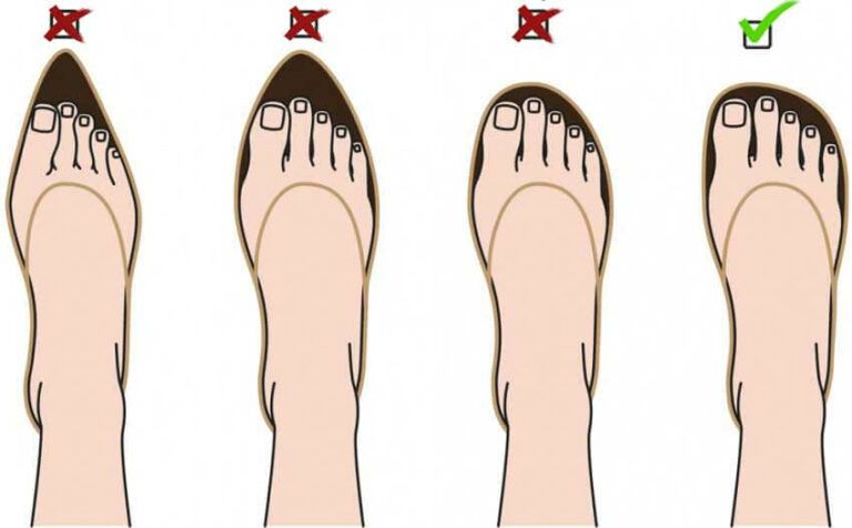 Overcrowded Toes: A Common Source of Foot Pain and Disorders