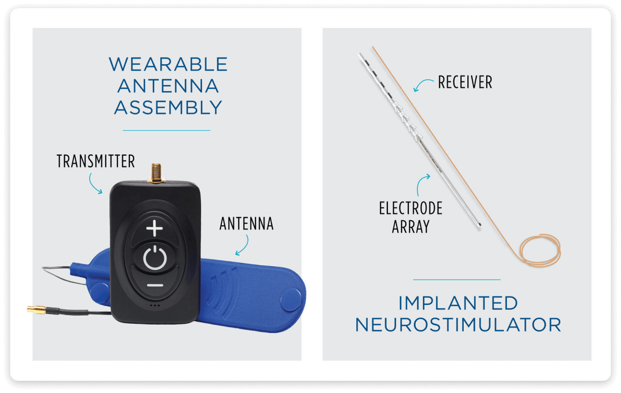 Peripheral Nerve Stimulator for Intractable Morton’s Neuroma